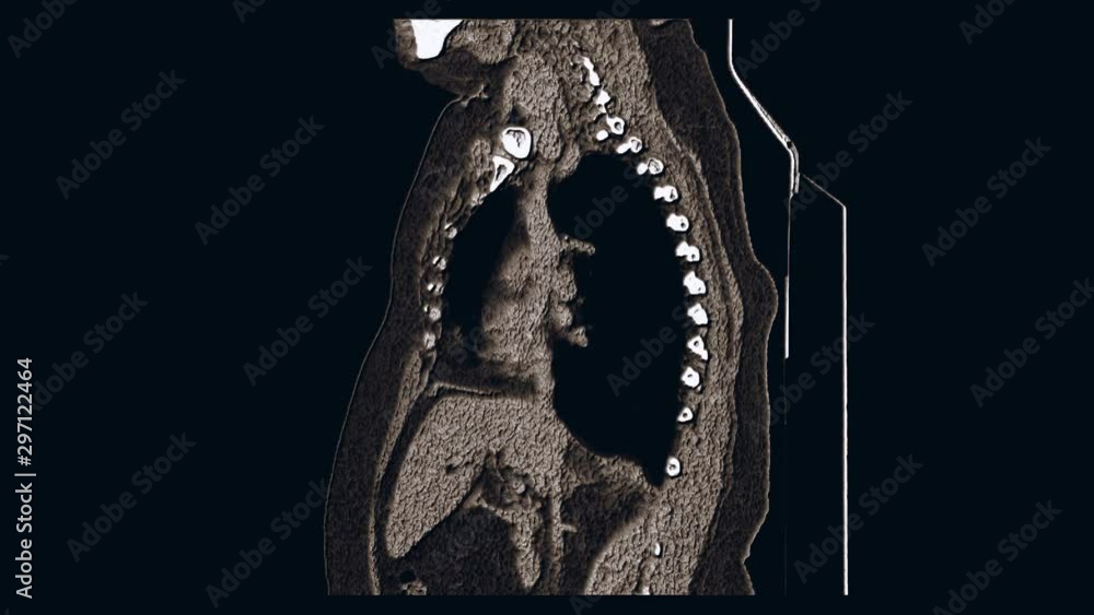 MRI scan of the lungs and bronchi, diagnosis of respiratory diseases ...