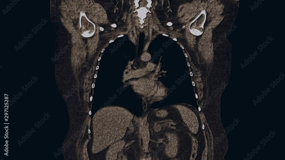 Volumetric MRI scan of the lungs and bronchi, diagnosis of respiratory ...