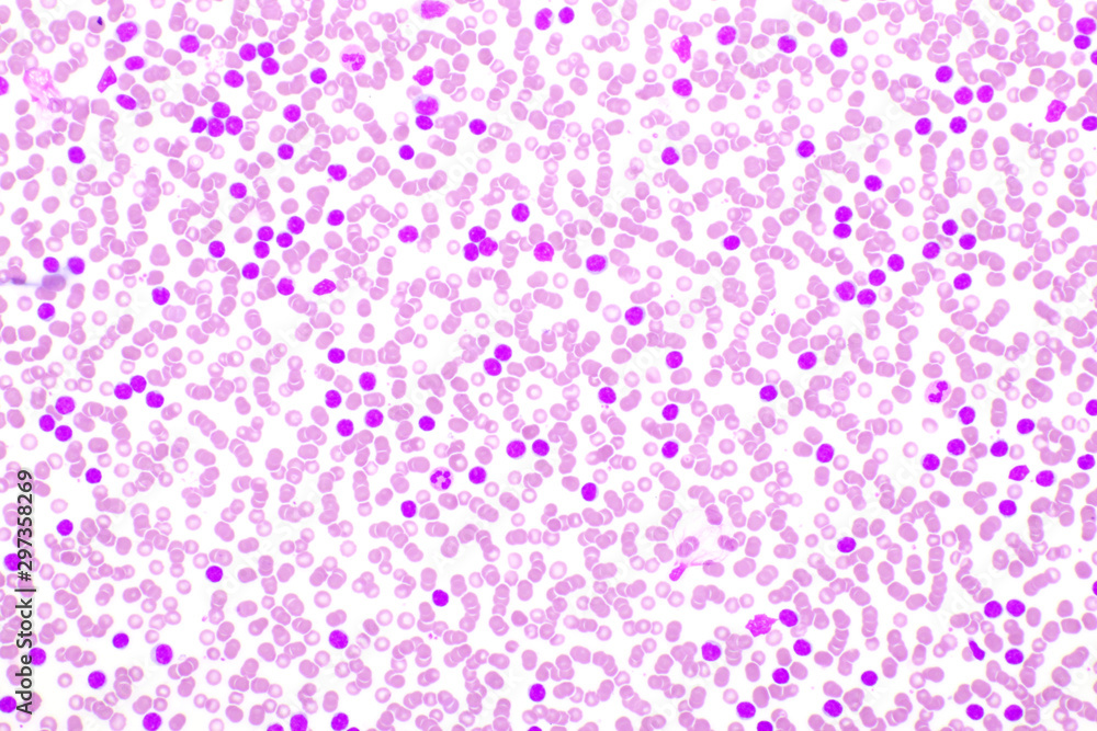 Blood picture of chronic lymphocytic leukemia or CLL, analyze by ...