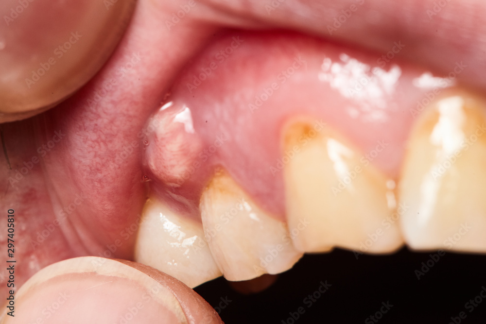 inflammation of the gums abscess closeup Stock Photo | Adobe Stock