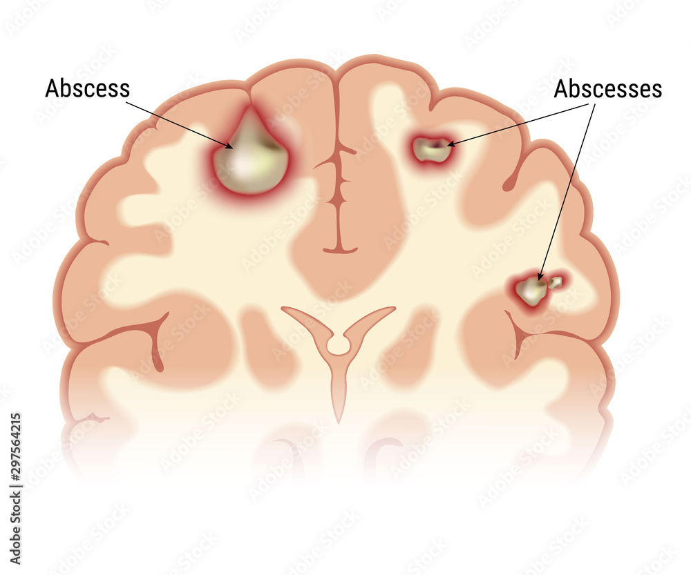 Intracerebral abscess of the human brain in the context. Visual image ...