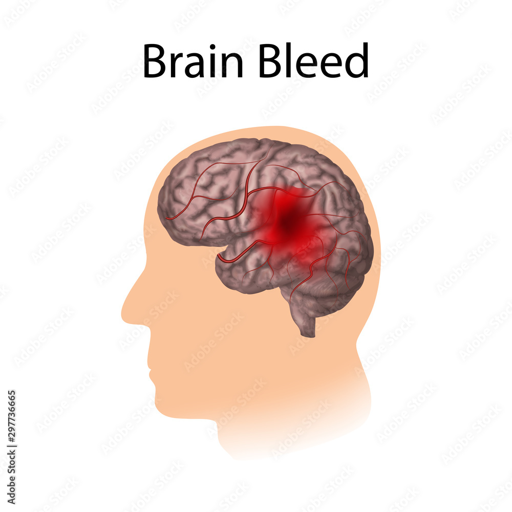 Brain bleed. Hemorrhage. Blood, head. Medical illustration. Stock ...