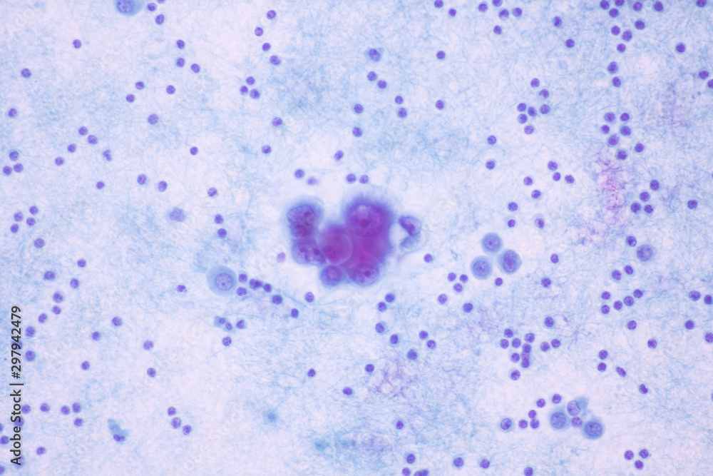 View in microscopic of abnormal human body effusion cells from pap ...