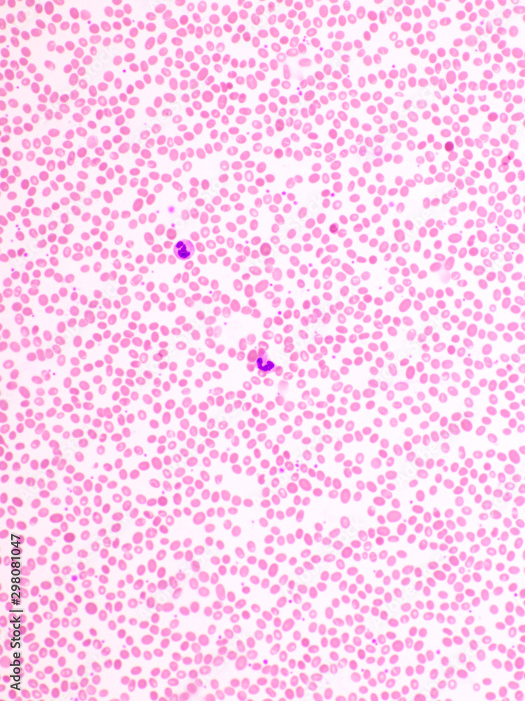 Picture of white blood cell, red blood cell and platelet in blood film ...