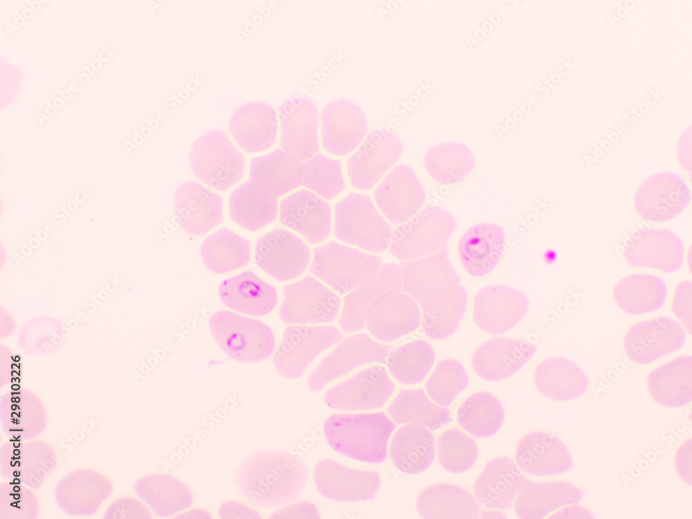 Malaria parasite in red blood cells, ring form stage of Plasmodium ...