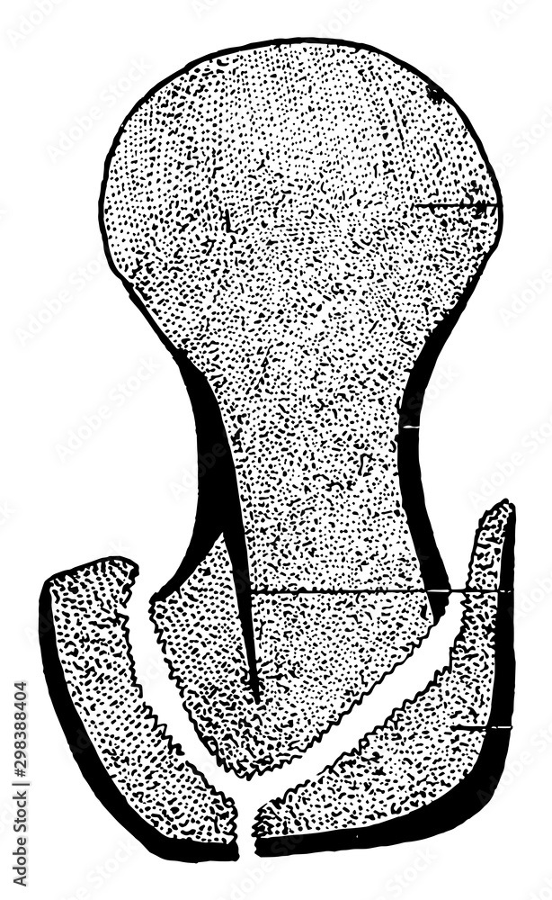 Calcar Femorale and its Relationship to Fractures of the Femur, vintage ...