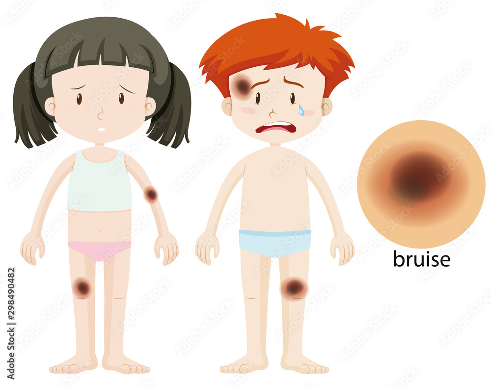Poster Boy and girl with bruise – Wall Art | UkPosters