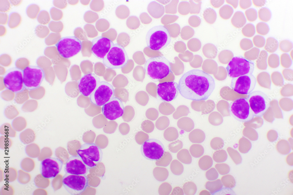Blood picture of chronic lymphocytic leukemia or CLL, analyze by ...