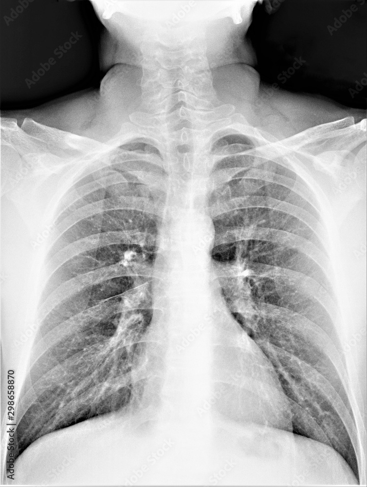 Foto de normal radiography of chest organs in direct projection ...