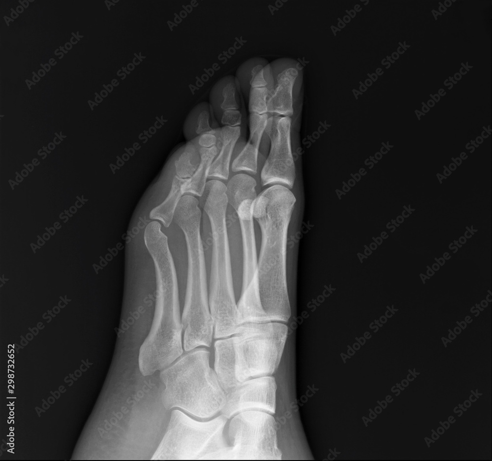 normal radiography of the foot, medical diagnostics, traumatology and ...