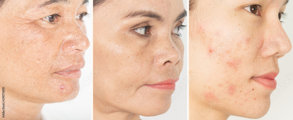 Face and differences. Age and skin. Dark spots. Stock Photo | Adobe Stock