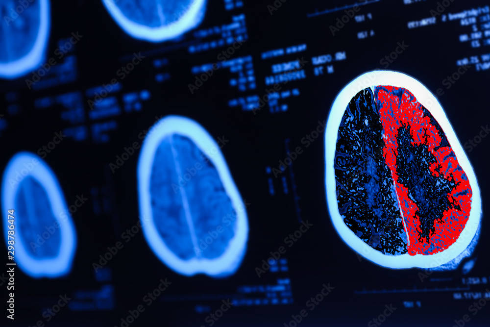 MRI of the brain.X-ray film of the brain computed tomography. Stock ...