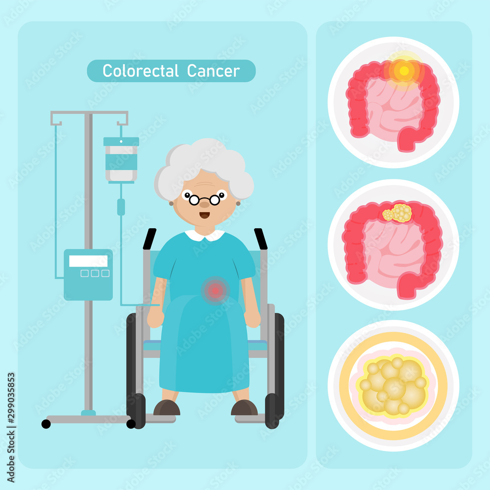 Colon Cancer Cartoon
