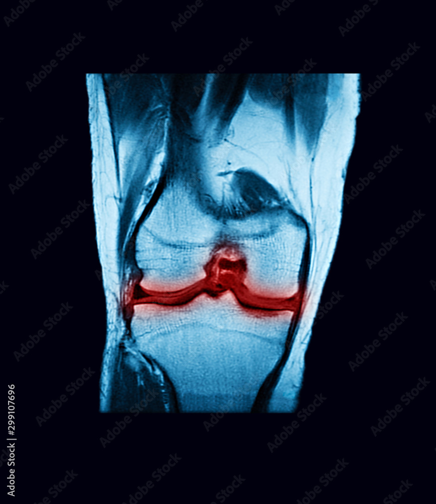 Magmetic resonance imaging (MRI-scan) of knee, Knee arthritis ...