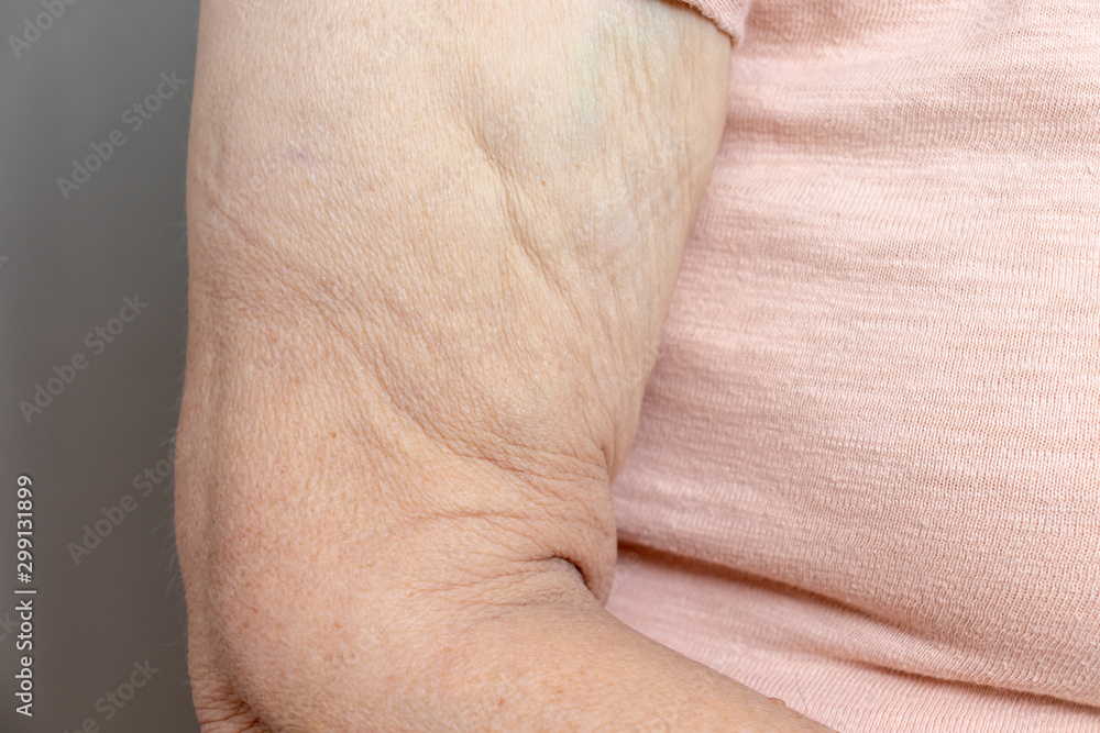 An excess loose skin on an arm of a senior elderly woman after extreme ...