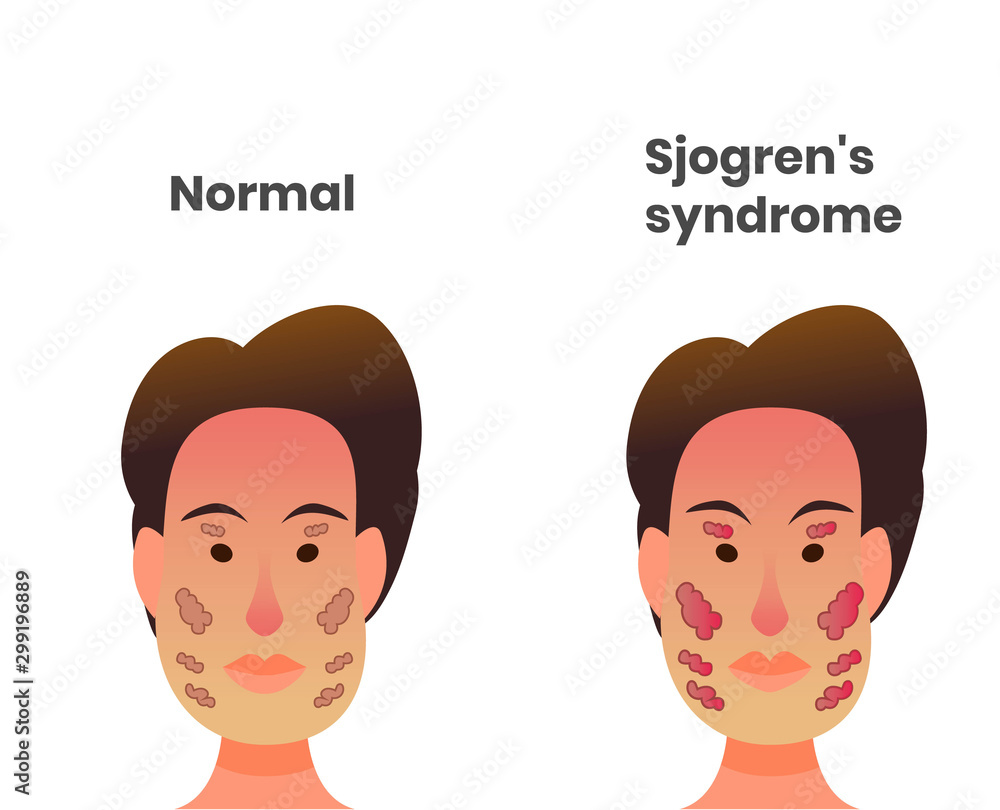 Normal lacrimal and salivary gland versus sjogren's syndrome Stock ...