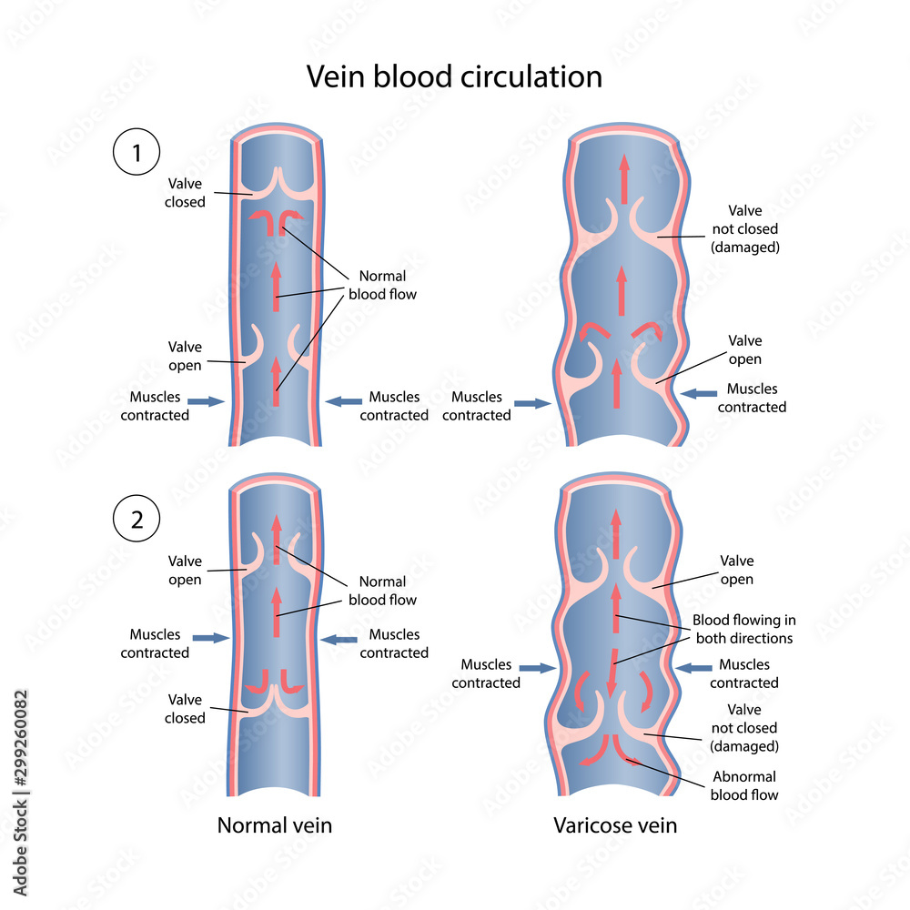 Comparative diagram of venous circulation with normal and varicose ...