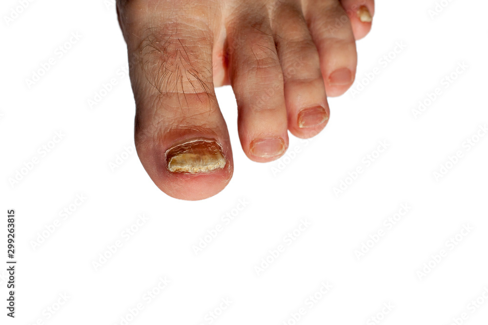 Fungus on toenails. Toenail plate is affected by fungus. Nail plates of ...