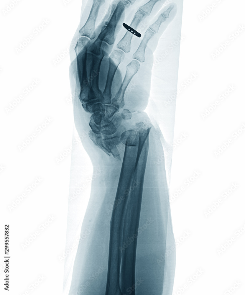 X-ray image of wrist joint, lateral view, showing distal ulnar and ...