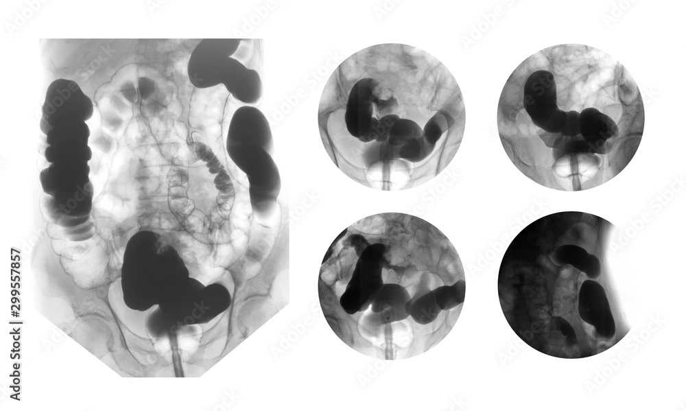 Lower gastrointestinal (GI) tract radiography (lower GI or barium enema ...