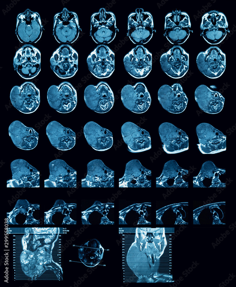 Magnetic resonance imaging (MRI scan) of neck, axial view, a case of ...
