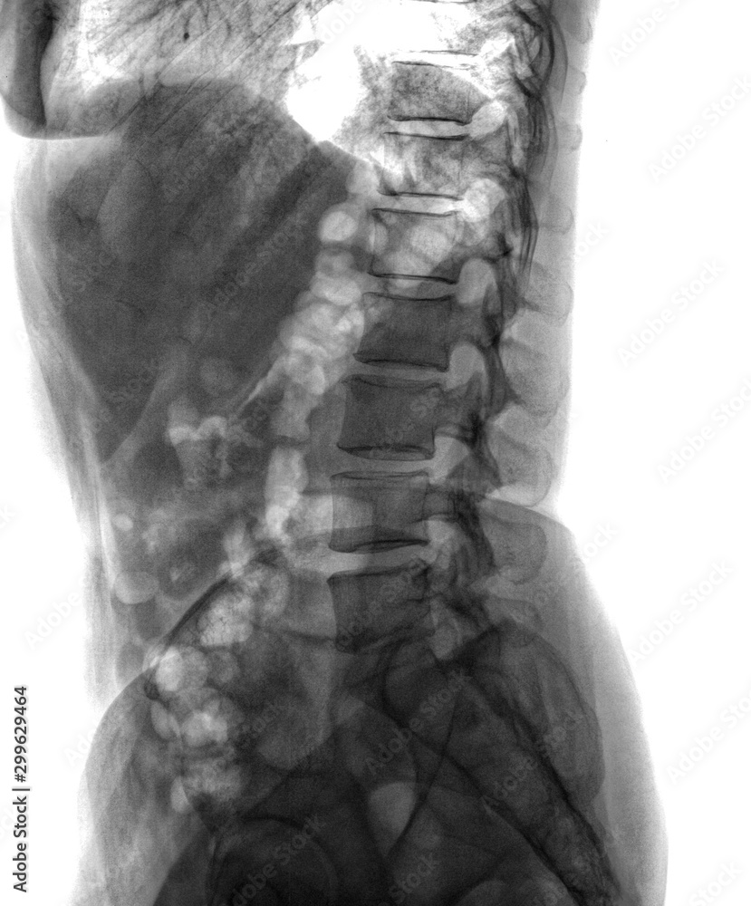 Diagnostic spinal X-ray film of a patient Stock Photo | Adobe Stock