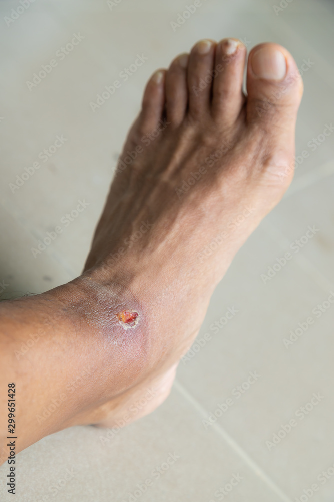Foot ulcers caused by disease. Stock Photo | Adobe Stock