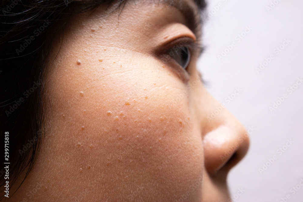 Seborrheic Keratosis on facial skin of asian woman. foto de Stock ...