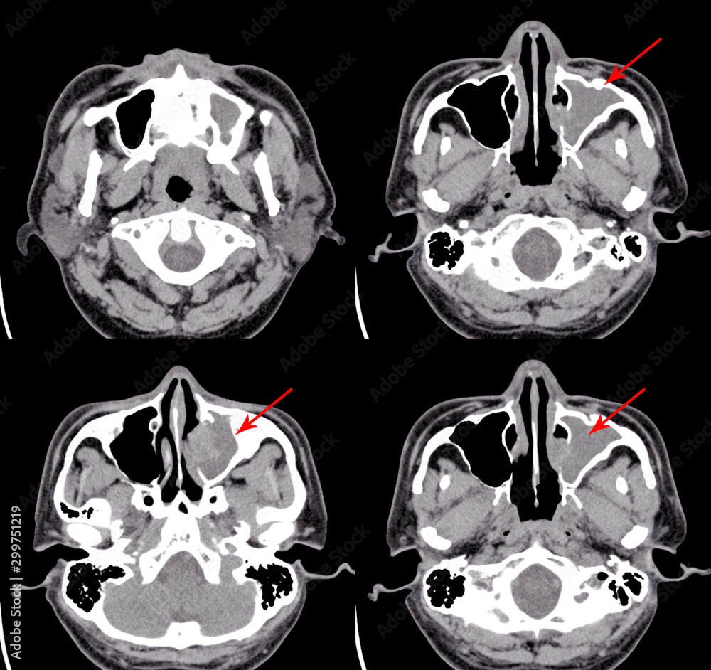 CT Brain and paranasal sinuses Impression: Chronic sinusitis of Lt ...