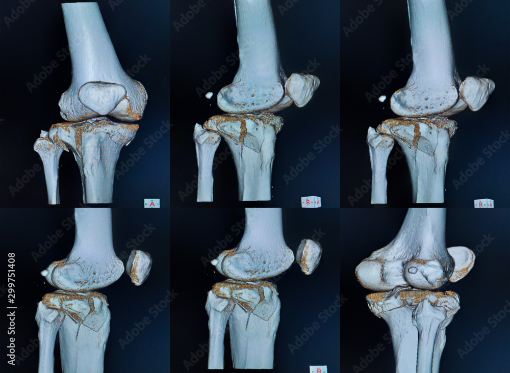 CT scan and 3D computer rendering image of a knee of the patient ...