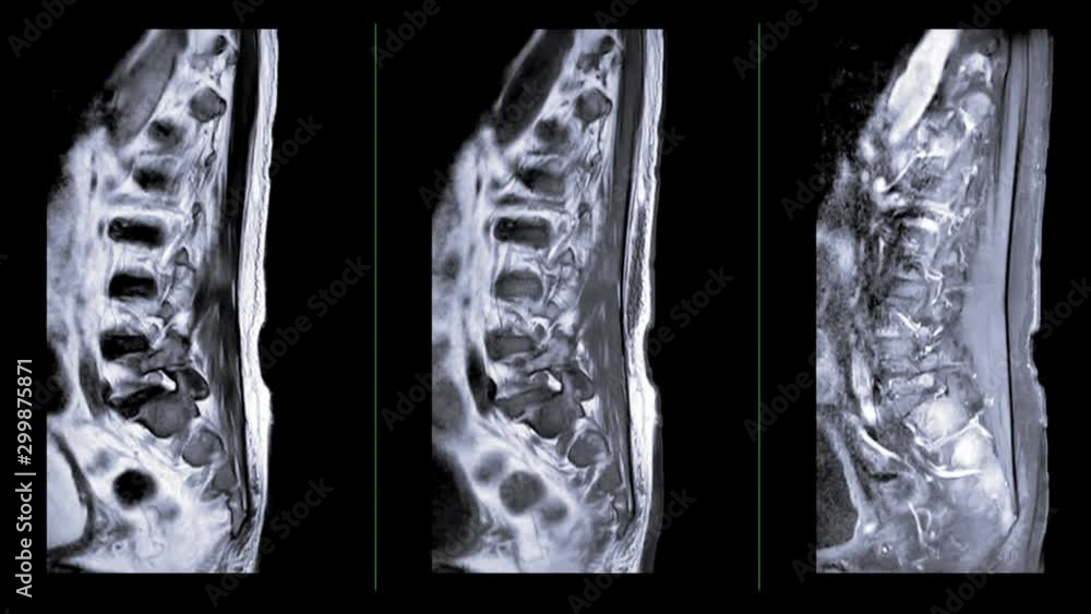 MRI L-S spine or lumbar spine on sagittal plane compare T1, T2 and T1 ...