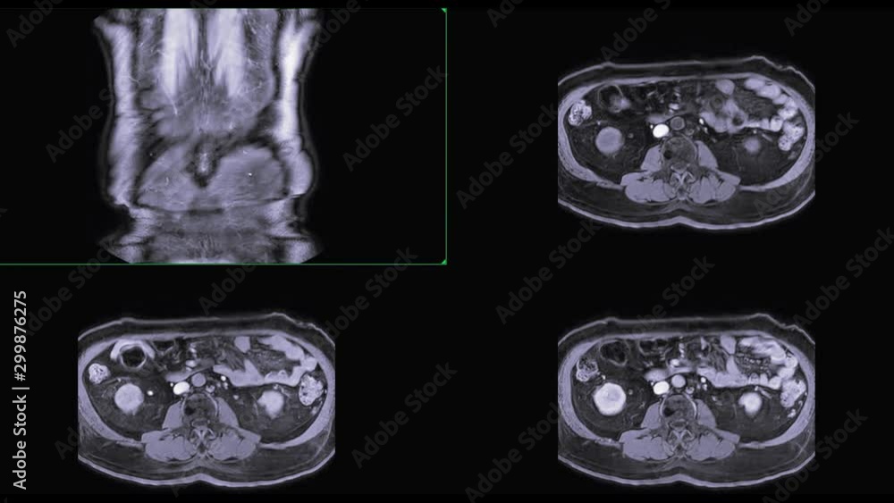 MRI Upper Abdomen compare Coronal, Axial T1, T2 and Axial T1 Post ...