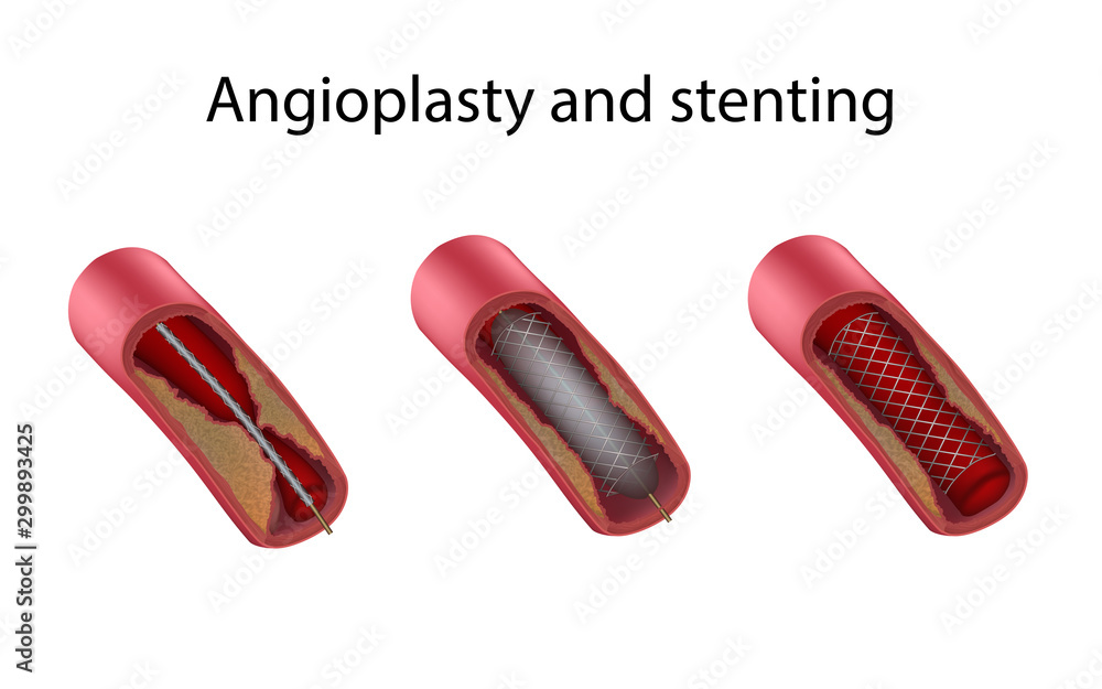 Angioplasty And Stenting Stages Medical Anatomy Illustration Stock