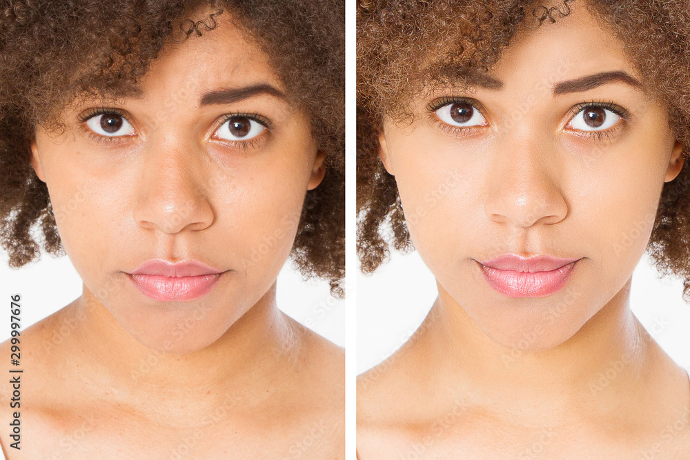 Foto de Before after close up african american woman face with acne and ...