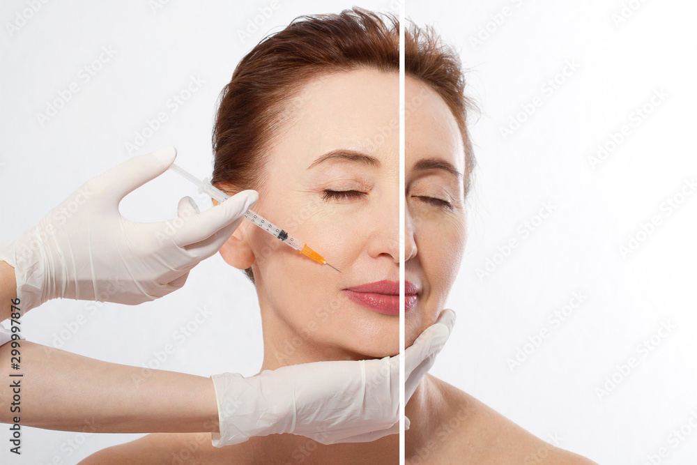 Closeup woman middle age face before after collagen face injection ...
