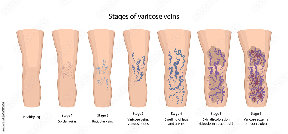 Póster Stages of varicose veins: spider, reticular, nodes, swelling ...