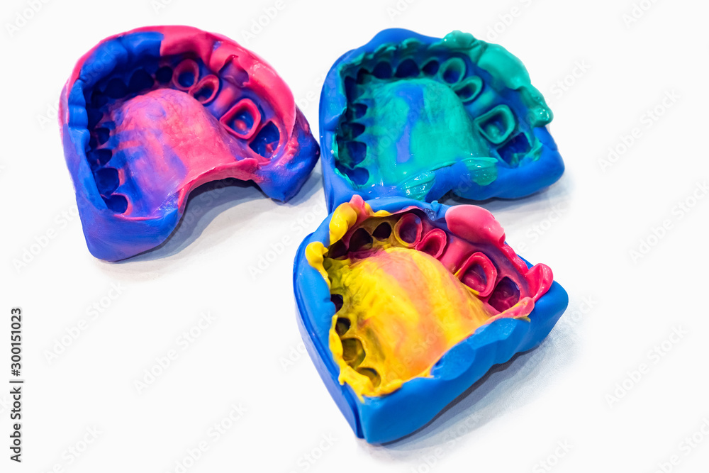 Plaster casts of the jaw. Anatomical teeth prints. Orthodontics ...