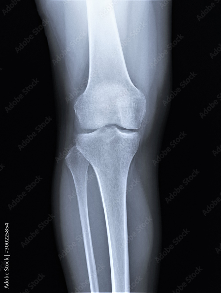normal radiography of the knee joint in direct projection, medical ...