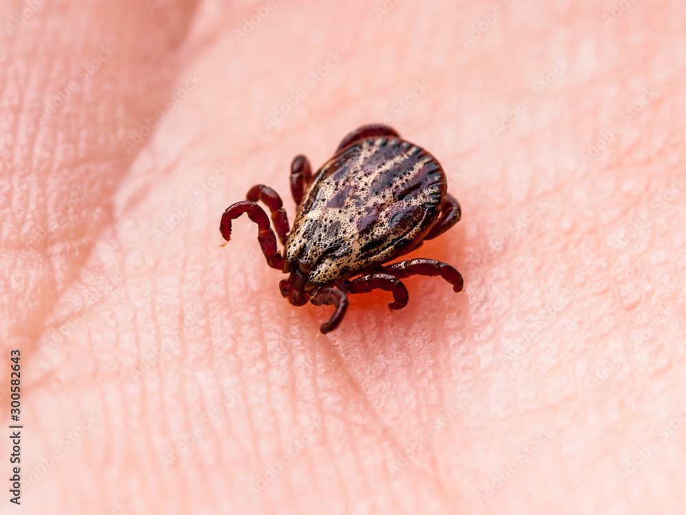 Infected Tick Insect Crawling on Skin. Encephalitis Virus or Lyme ...