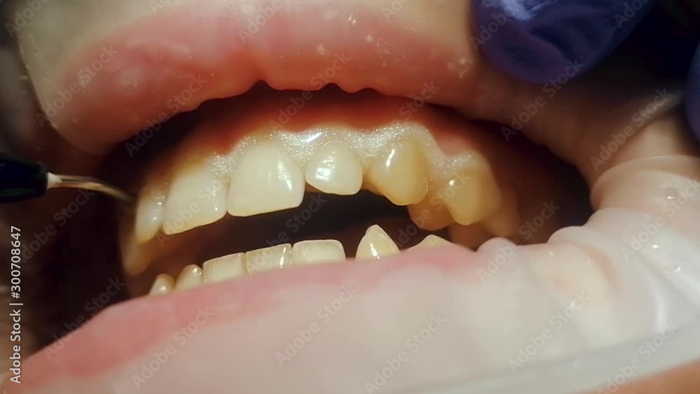 On incisors, liquid rubber dam, composite, photopolymer for bleaching ...