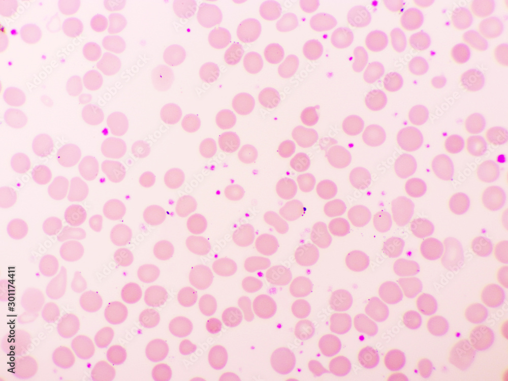 Essential thrombocytosis blood smear, present abnormal high platelet ...