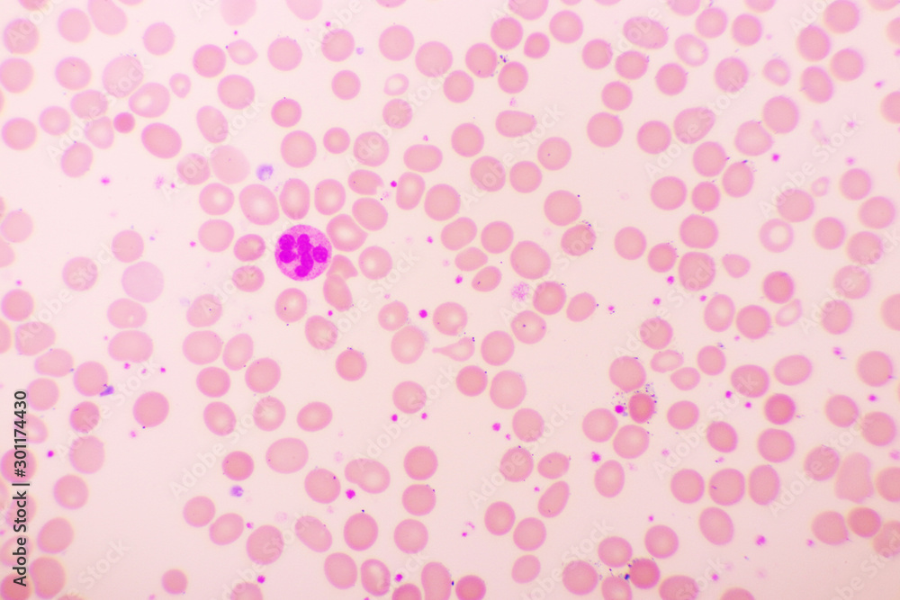 Essential thrombocytosis blood smear, present abnormal high platelet ...