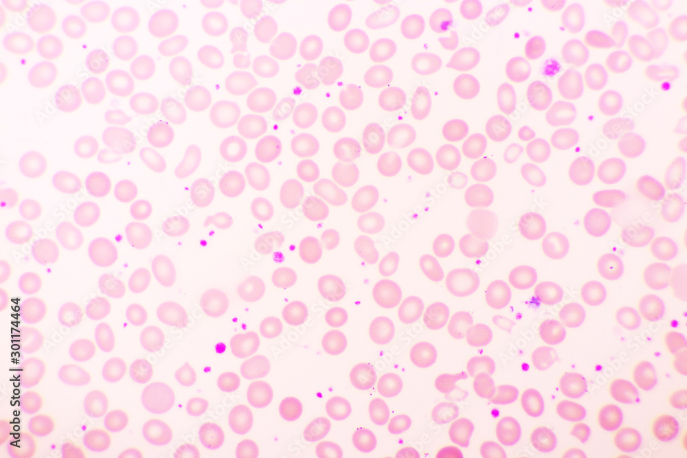 Essential thrombocytosis blood smear, present abnormal high platelet ...