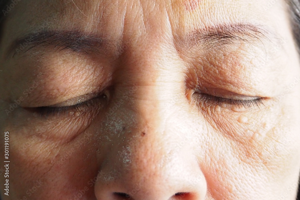 Closeup of wrinkles in Asian woman face skin in deep layers. Skin ...