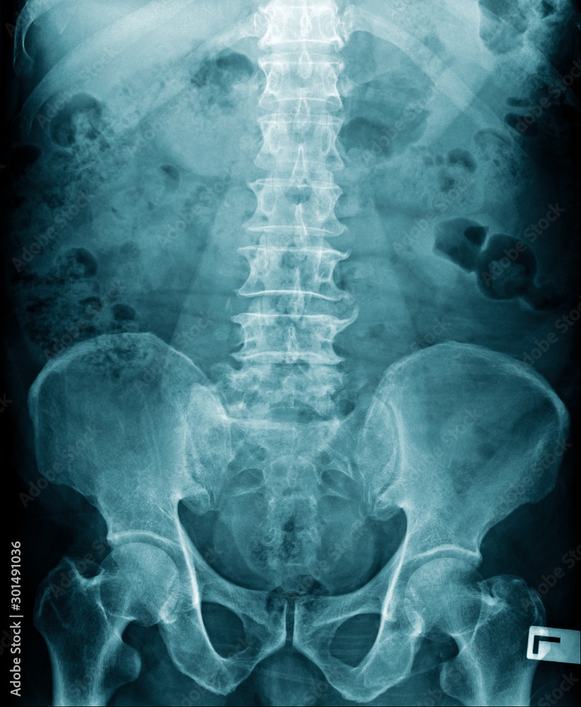 x-ray image of human spine and show lumbar spondylosi Stock Photo ...
