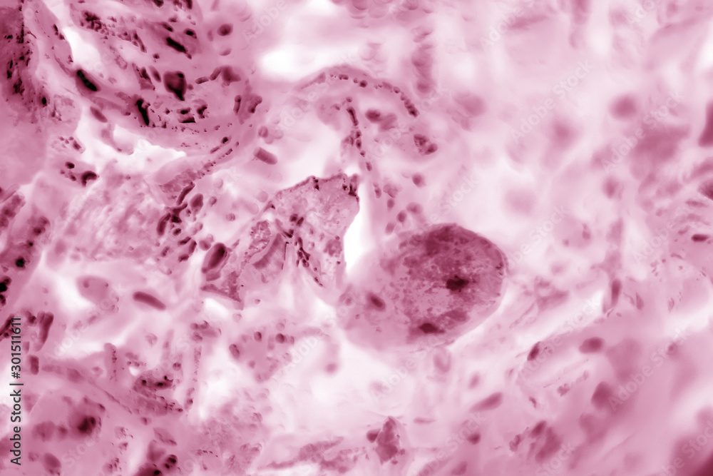 cancer cells under the microscope. Tissues affected by cancer cells ...