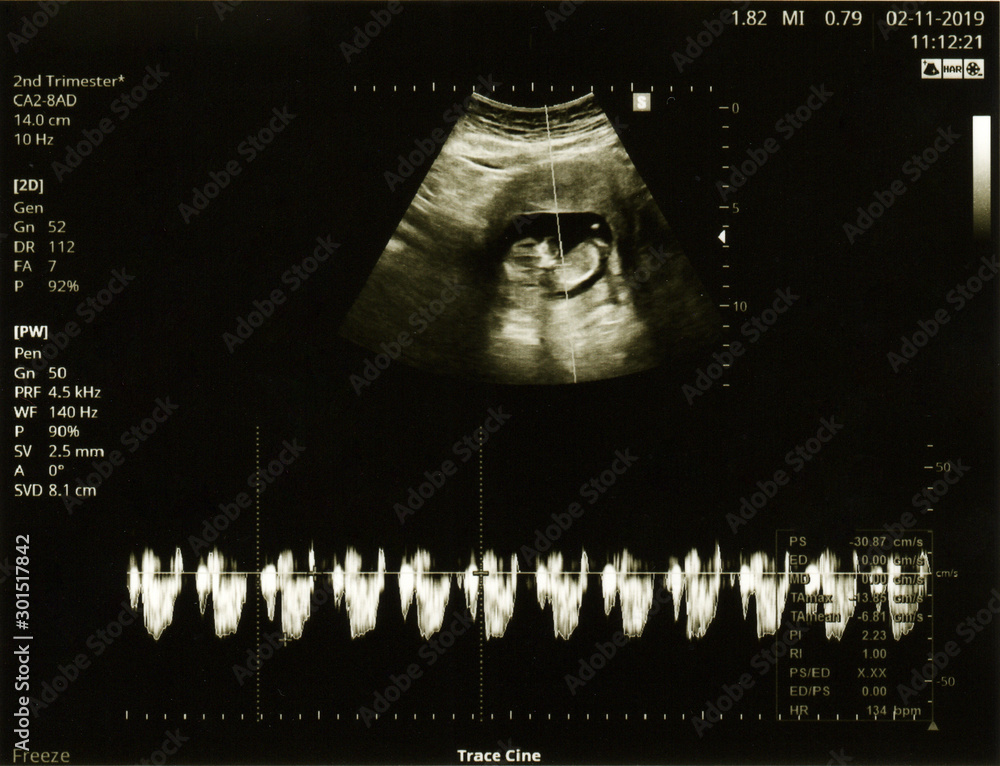 Film Ultrasound (US) whole abdomen of a 40 years old female patient ...