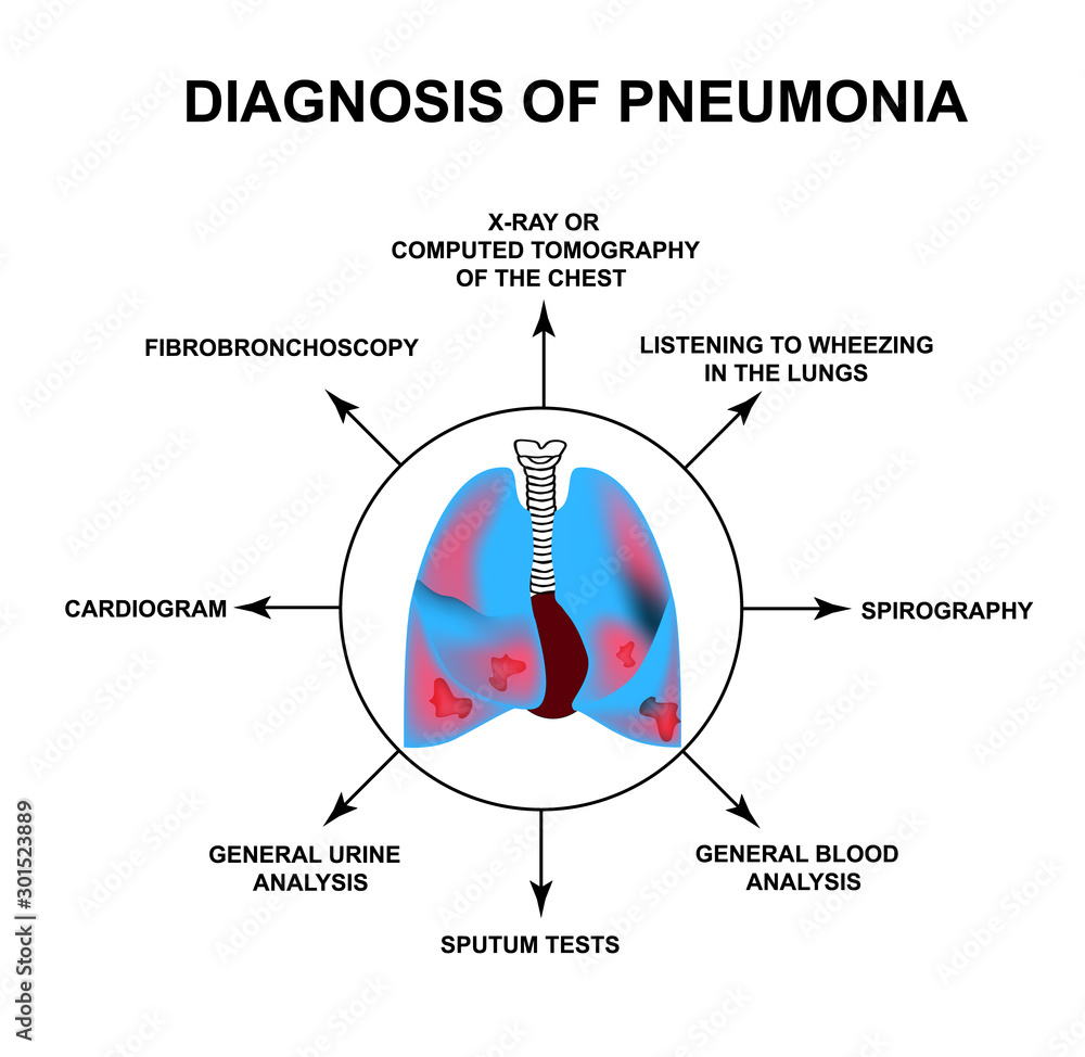 Diagnosis of pneumonia. Human respiratory organs. World Pneumonia Day ...