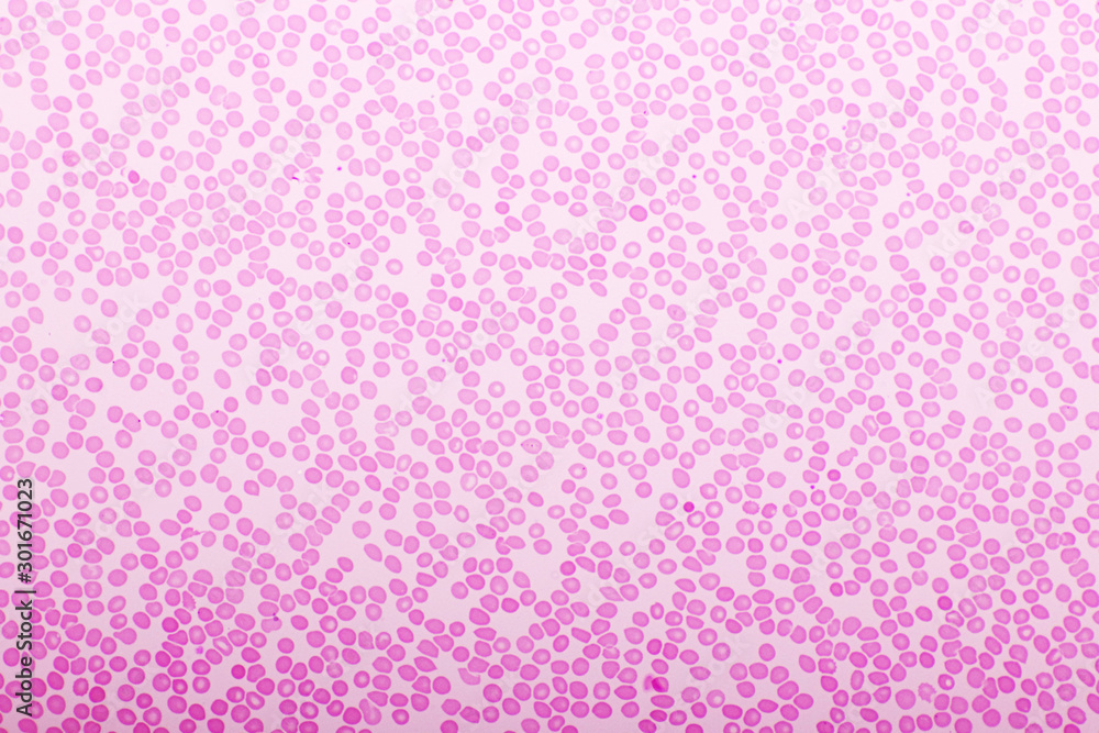 Red blood cells in blood smear, Wright-Giemsa stain, analyze by ...