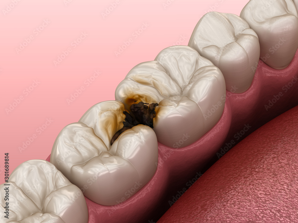 Molar teeth damaged by caries. Medically accurate tooth 3D illustration ...